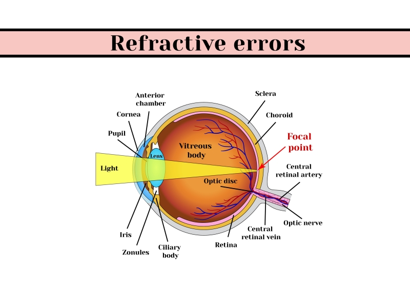 Refraction errors – An excellent in healthcare solutions